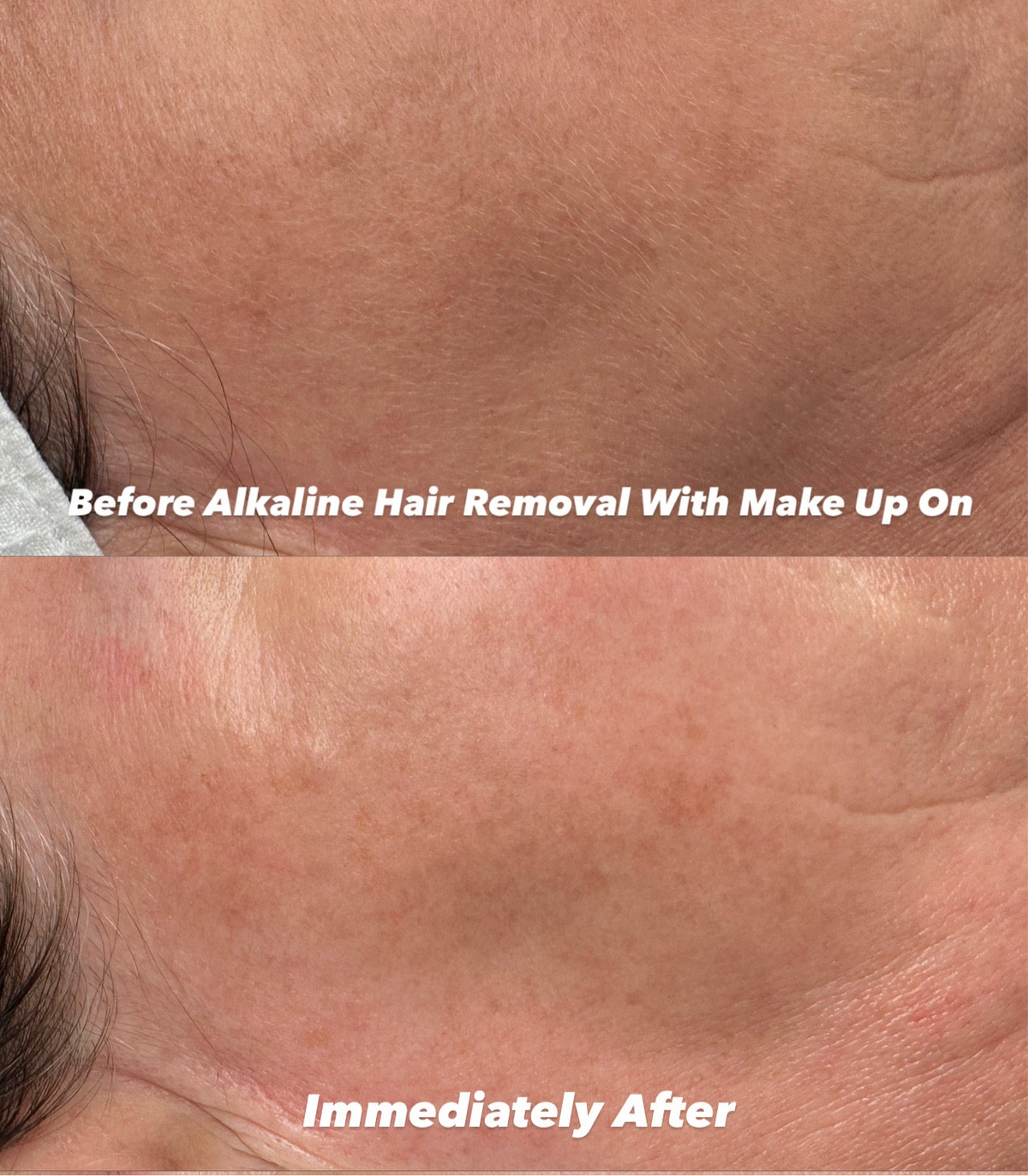 Alkaline Hair Removal – Prestige Skin Revision