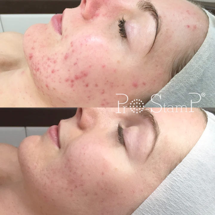 Skin Needling Pro Stamp - Full Face – Prestige Skin Revision