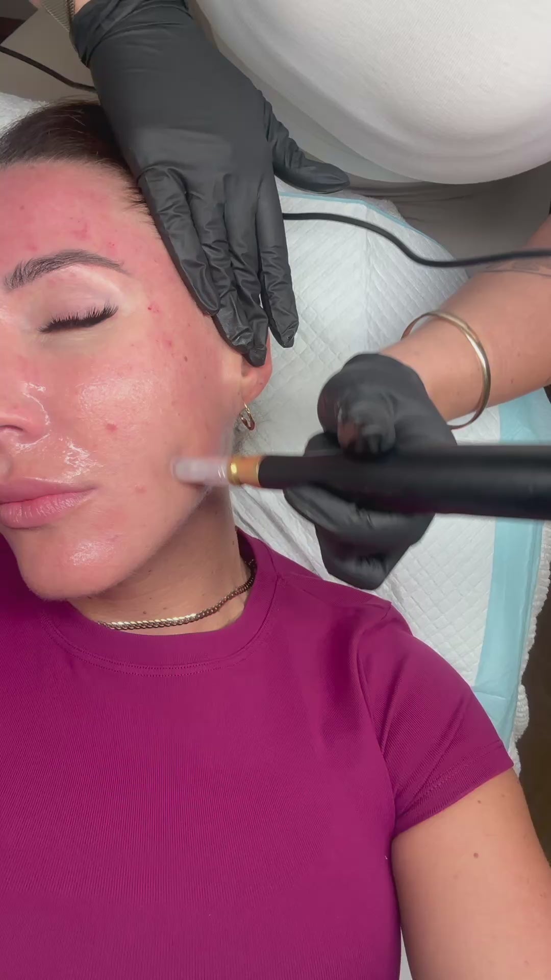 Micro Needling Code X Meso Therapy NCFT – Prestige Skin Revision